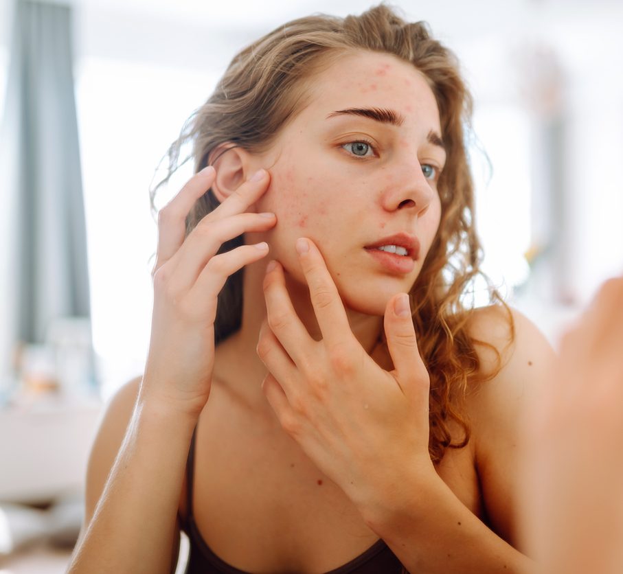 Acne Treatment in Midland, TX | REVIVAL